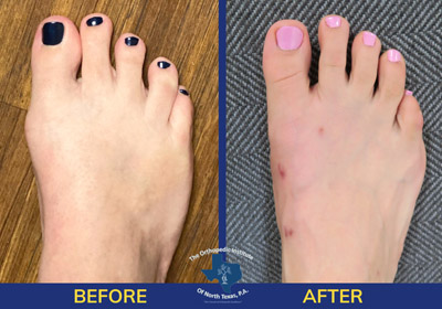 Before and After Photos Dallas, TX | Minimally Invasive Bunion Surgery