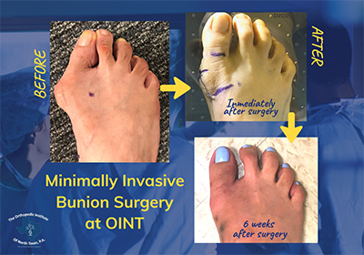 Minimally Invasive Bunion Surgery Dallas, TX | Ankle Ligament Tear ...